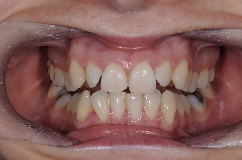 Patient Journey - Braces & Clear Aligners | Union Quay Dental